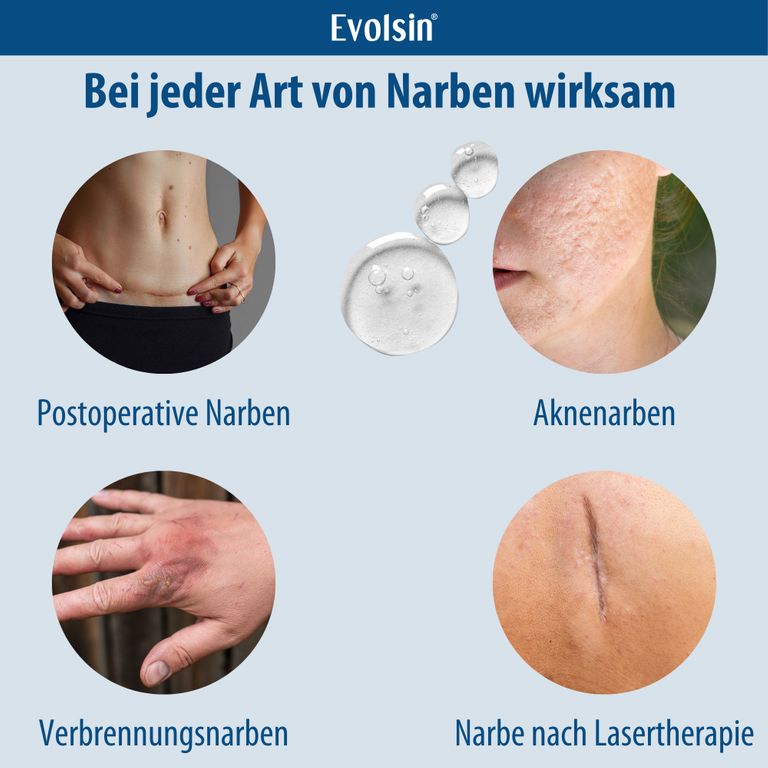 Evolsin® Narbengel für Kinder & Erwachsene – Narbensalbe reduziert die ...