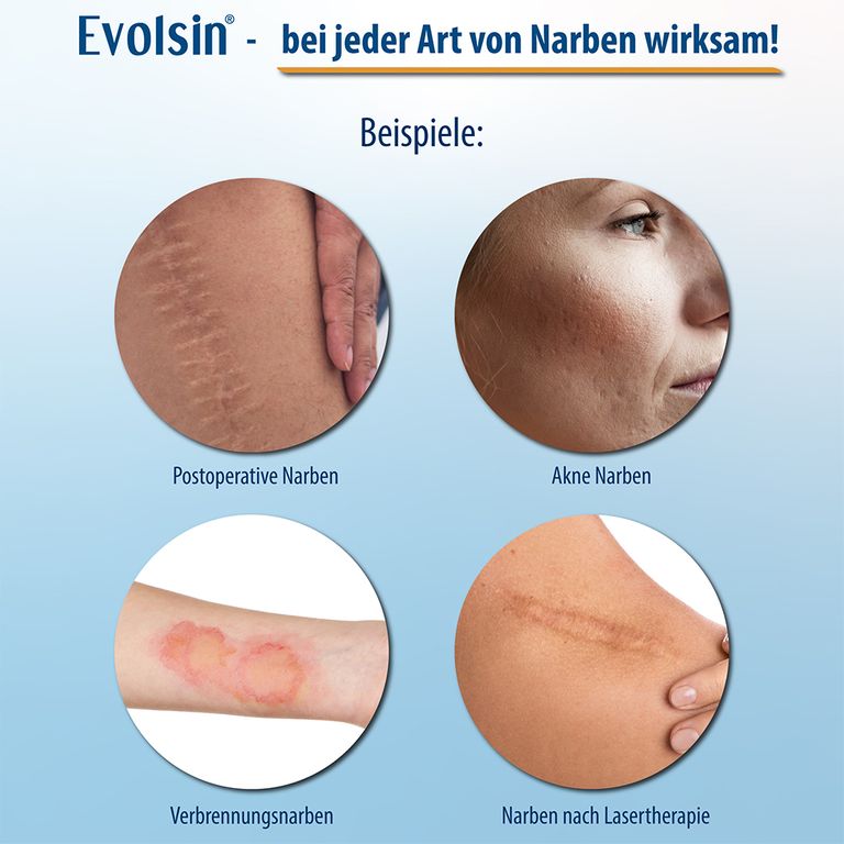Evolsin® Transparentes Narbenpflaster – für Narben aller Art ...