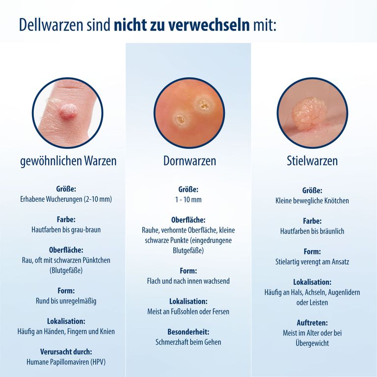 Evolsin® Dellwarzen Mittel I Für Erwachsene & Kinder ab 2 Jahren I Dellwarzen Behandlung mit ...